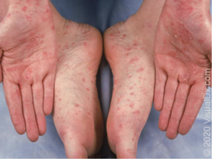 Sífilis - Infectología Online